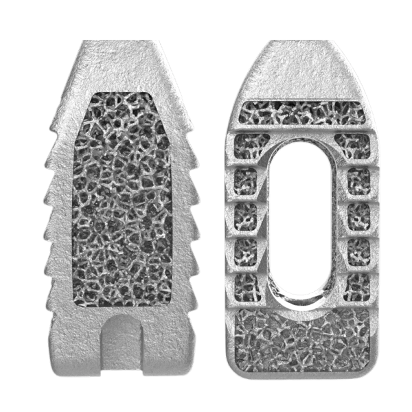 Pyxis™ TPLIF 3D-Titanium Cage | OneSurg